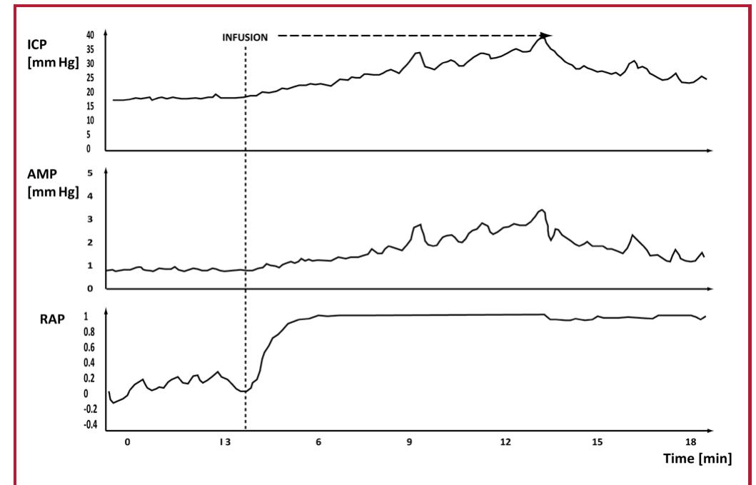 Typical example of change of mean icp, amp of icp wave-
