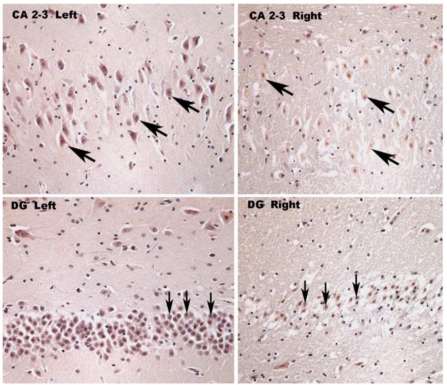 Figure 4 - from Neuropathological and MRI findings in an