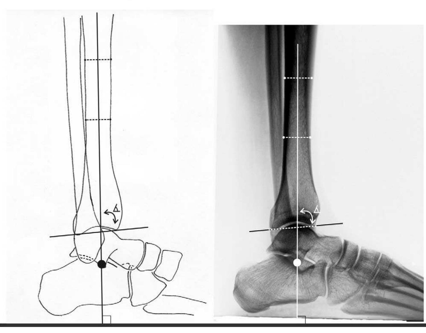 Anterior distal tibial ankle (adta) figure 8 the anterior