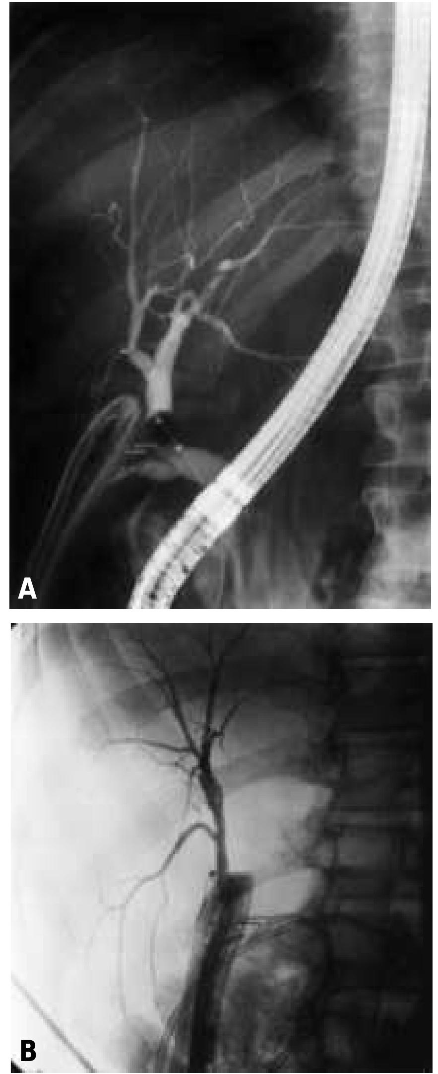 A, patient with persistent biliary leakage from a j