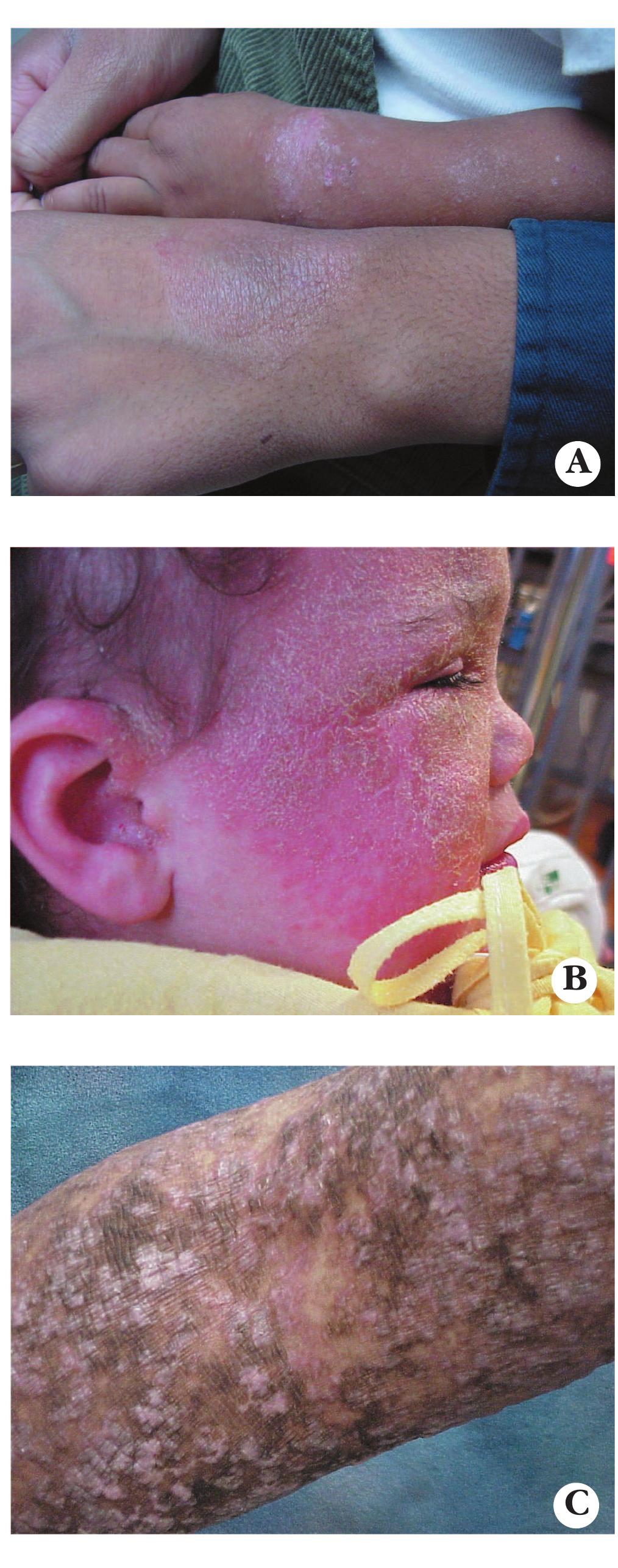 Clinical appearance of atopic dermatitis lesions in