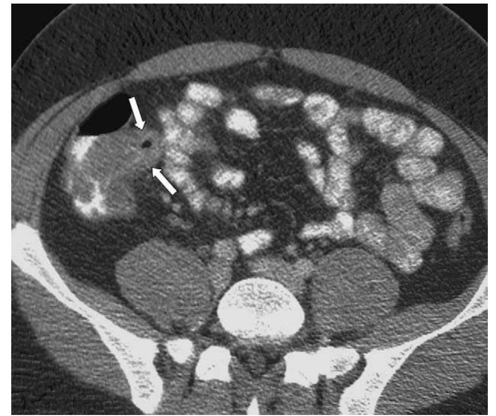Appendiceal typhoid. axial ct image of the abdomen following