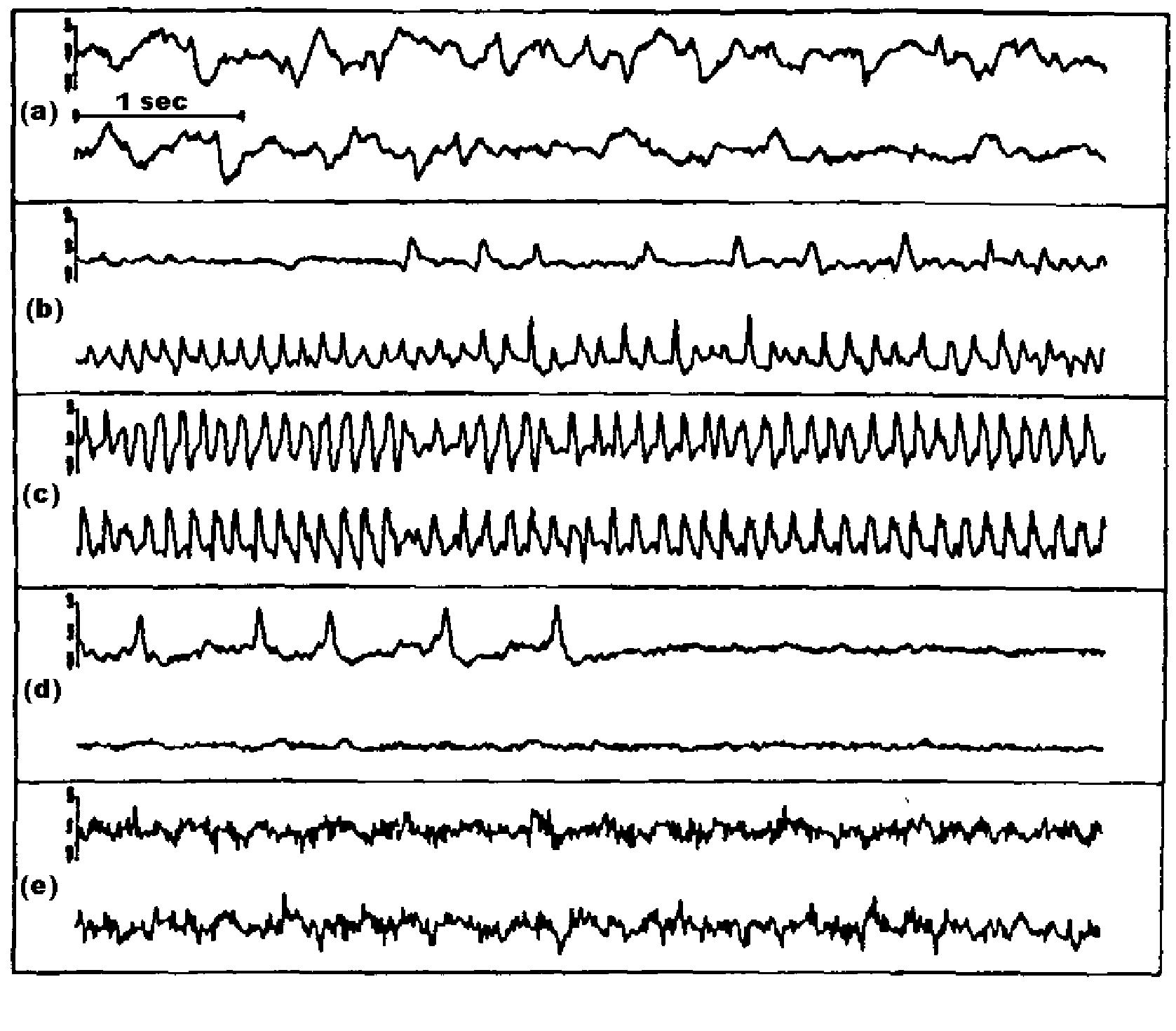 Five eeg segments from different stages of a human epileptic