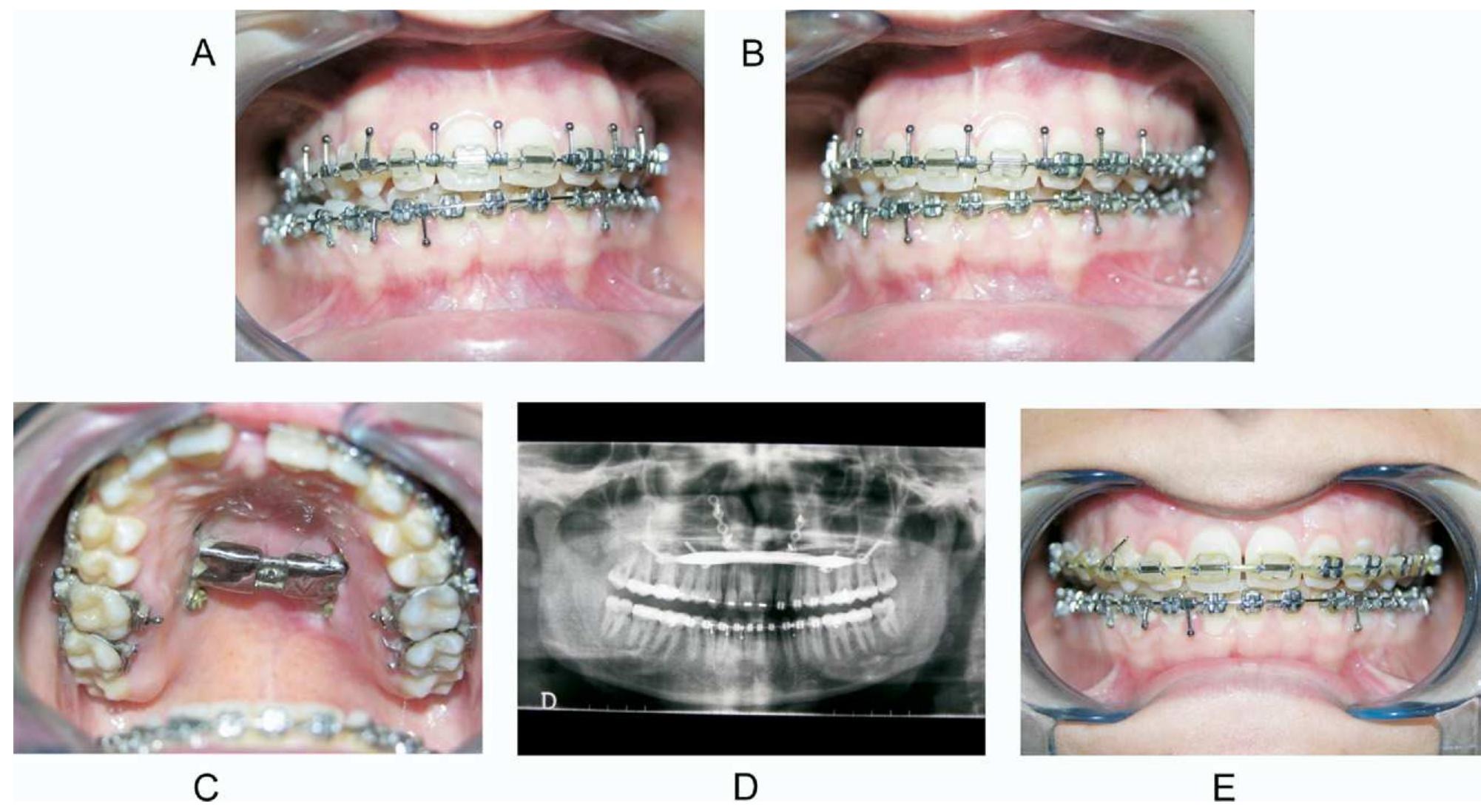 Patient 1. a, preoperative occlusal frontal view. b,