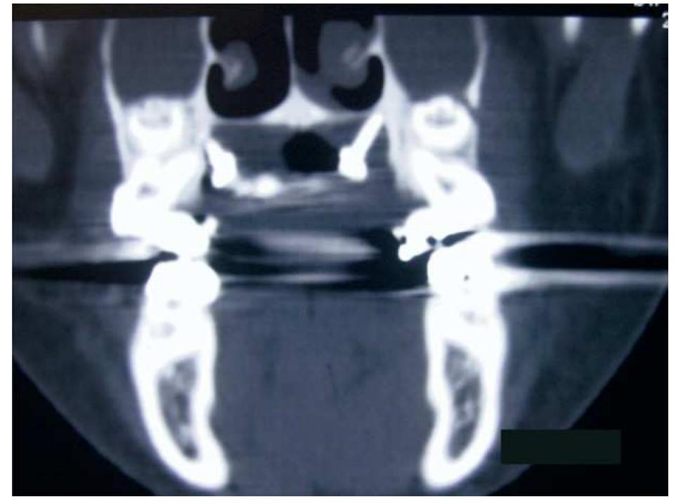 Representative ct scan (coronal view) showing correct