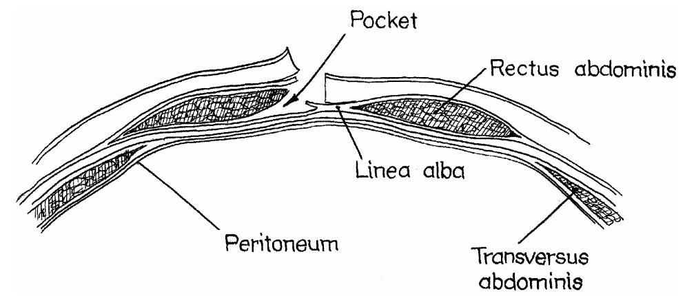 Cross-sectional diagram of the abdomen for a subxyphoid