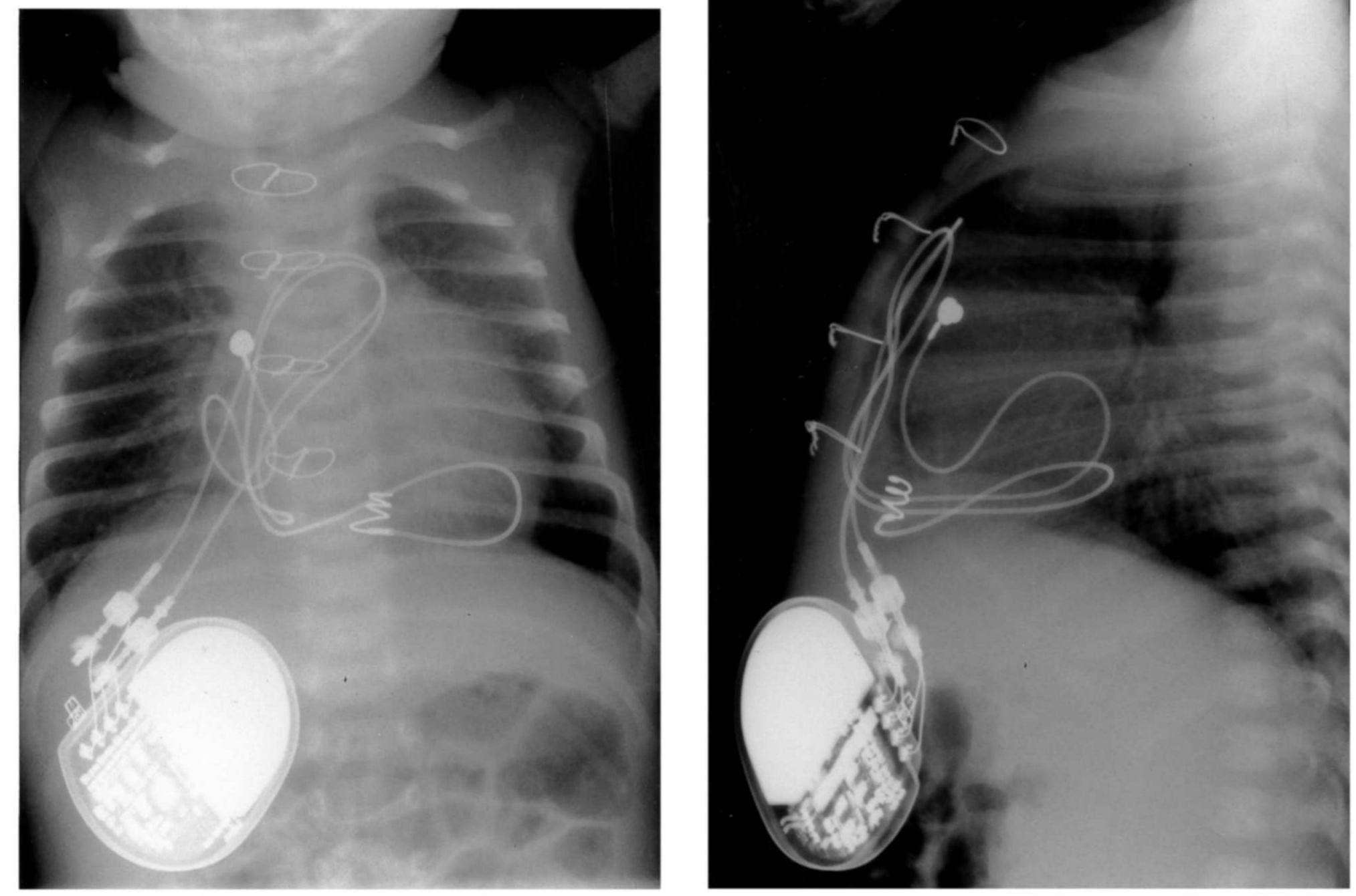 Infant with double-inlet left ventricle and pulmonary