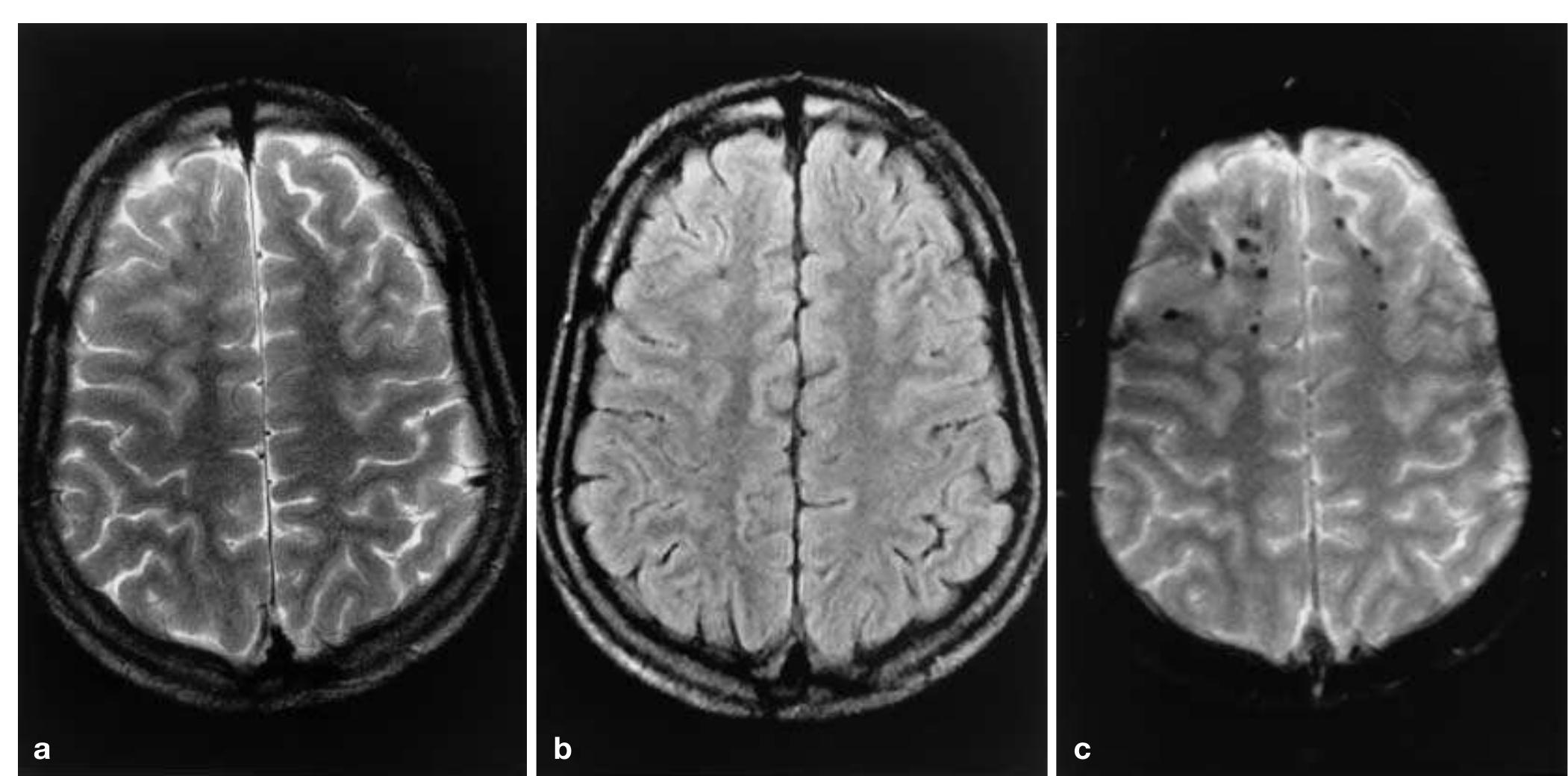 Figure 9 - from Intracranial hemorrhage: principles of CT