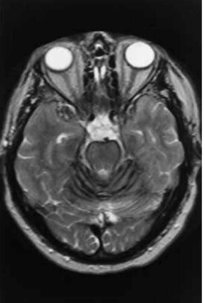 Figure 12 - from Intracranial hemorrhage: principles of CT