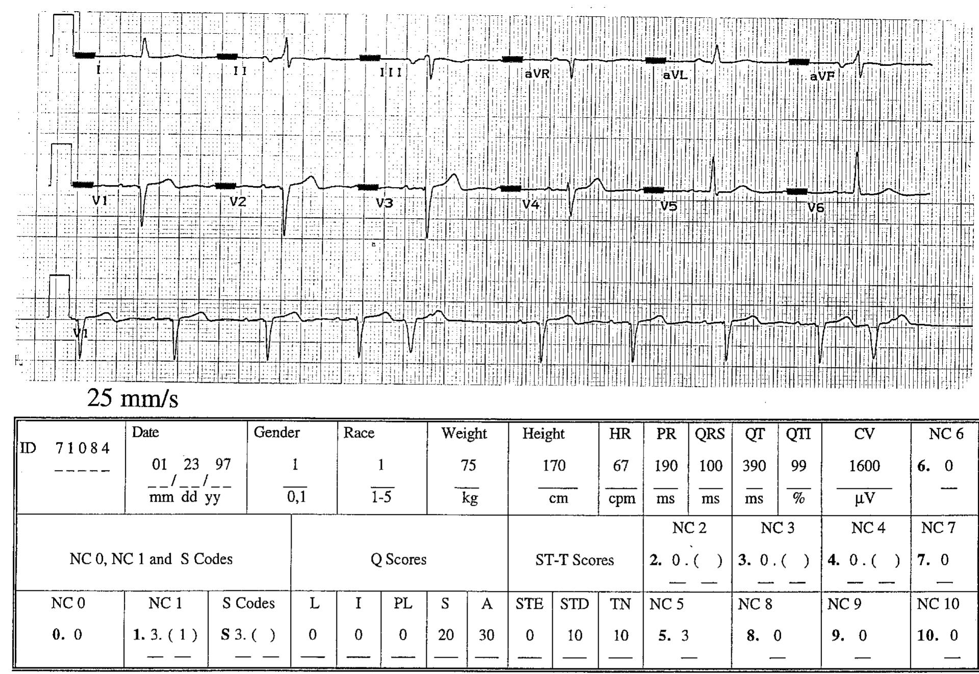 A simplified procedure for coding of prevalent ecg