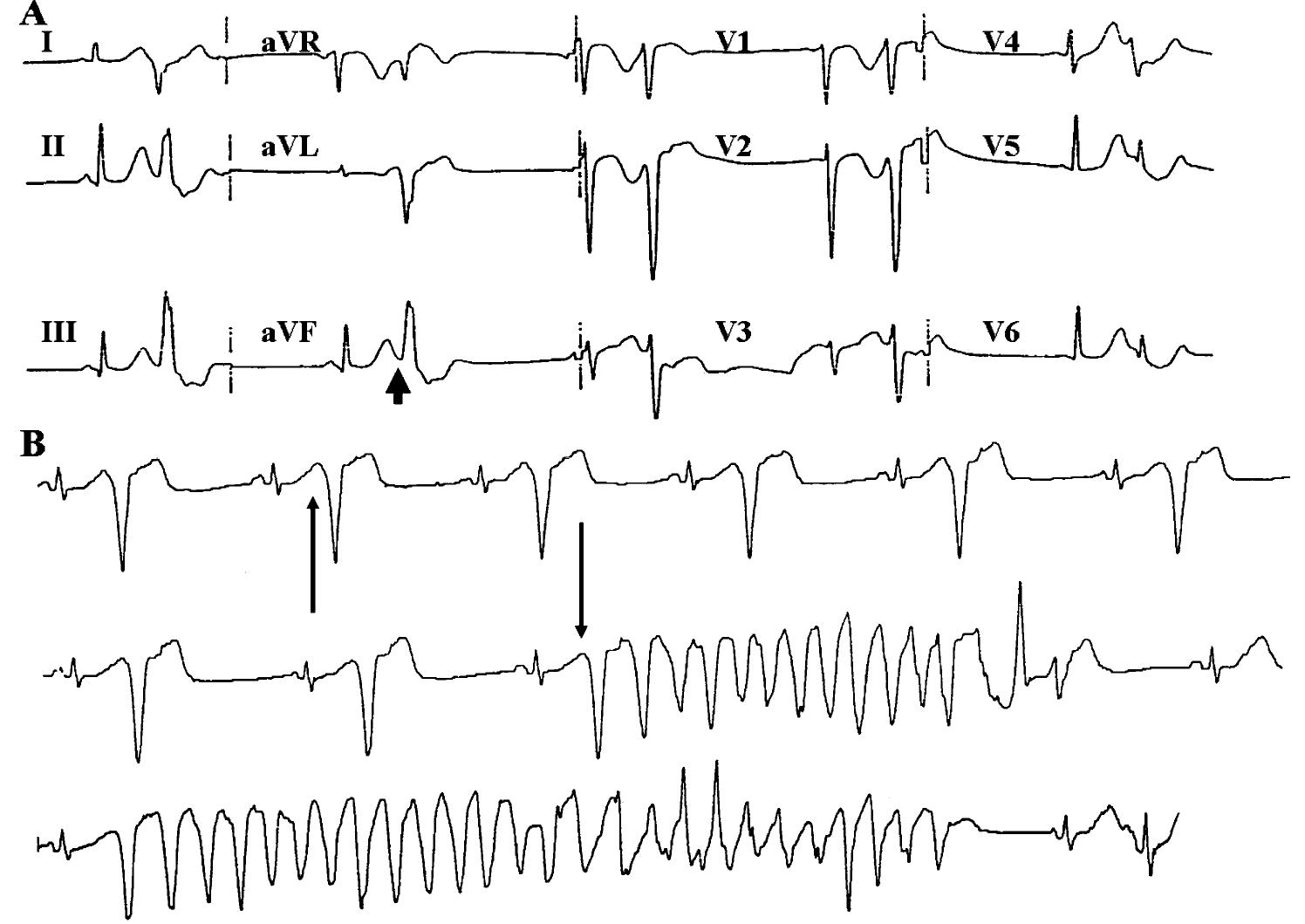 Case 1. syncopal nonsustained polymorphic vt in a woman who