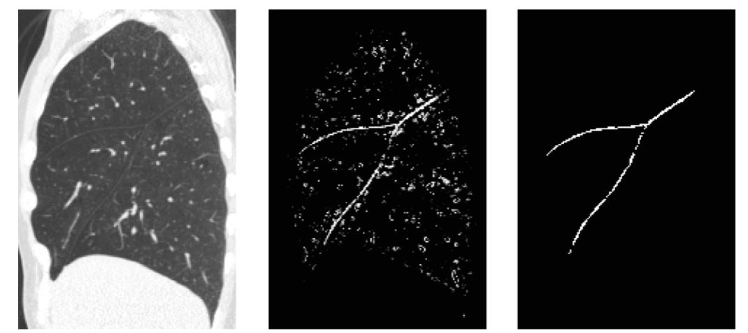 Example of the fissure segmentation, (a) the original ct