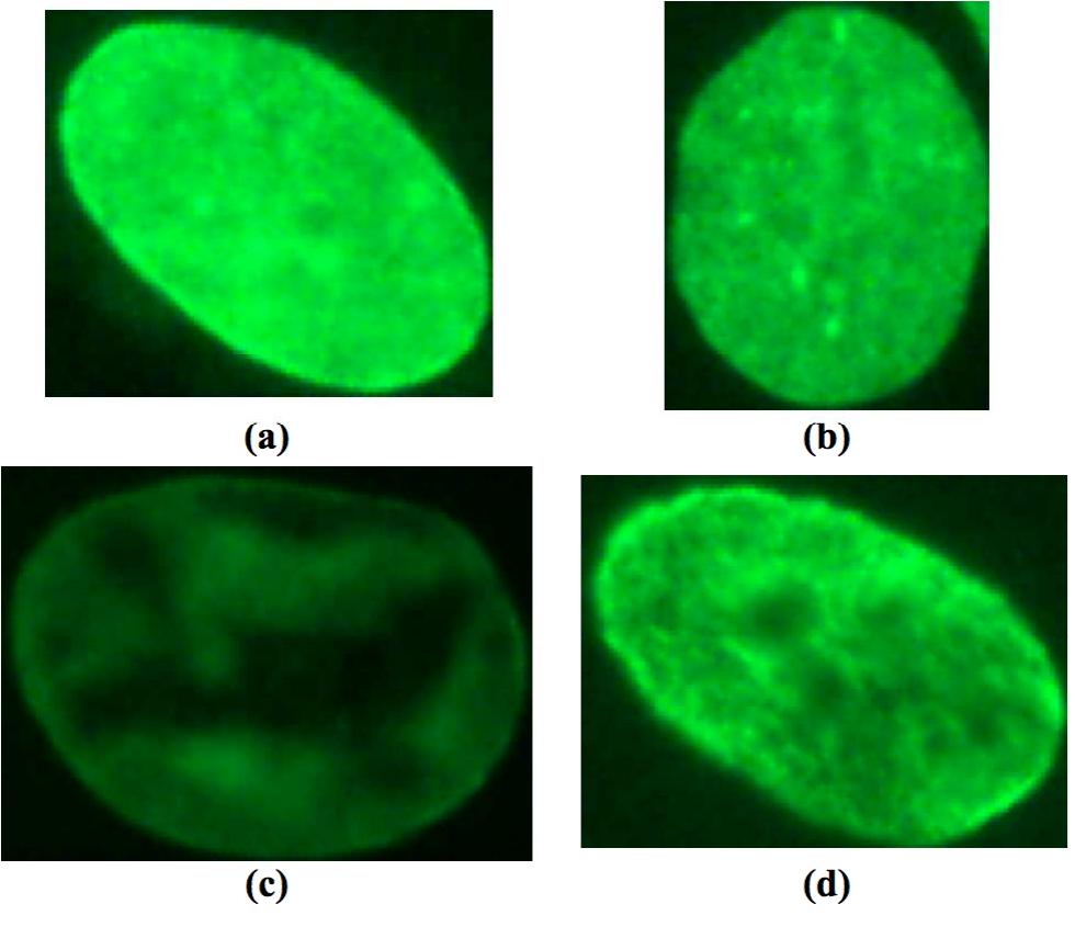 Abnormal nuclei to be compared with the classification made