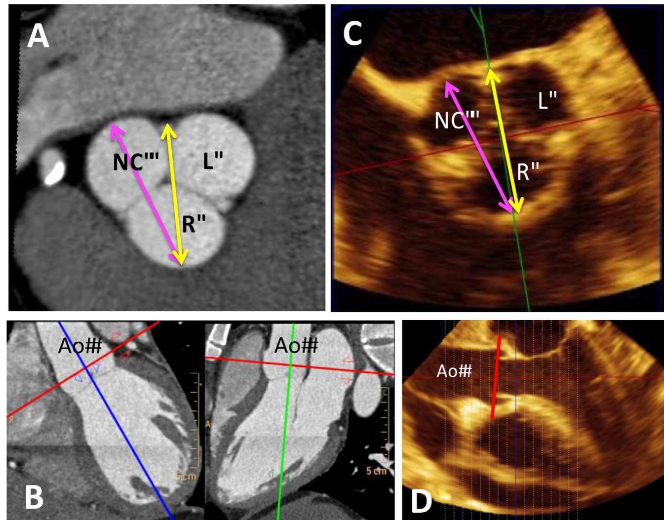 The smaller (anteroposterior, sagittal) aortic root diameter