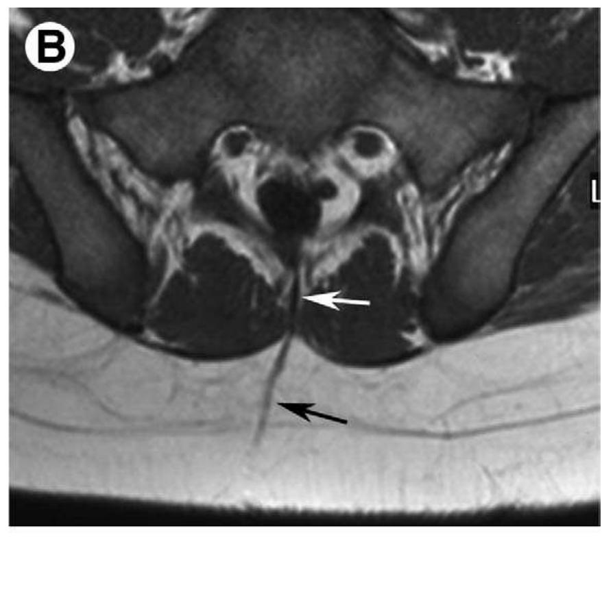 Dermal sinus, 11-year-old boy. (a) sagittal t1- weighted