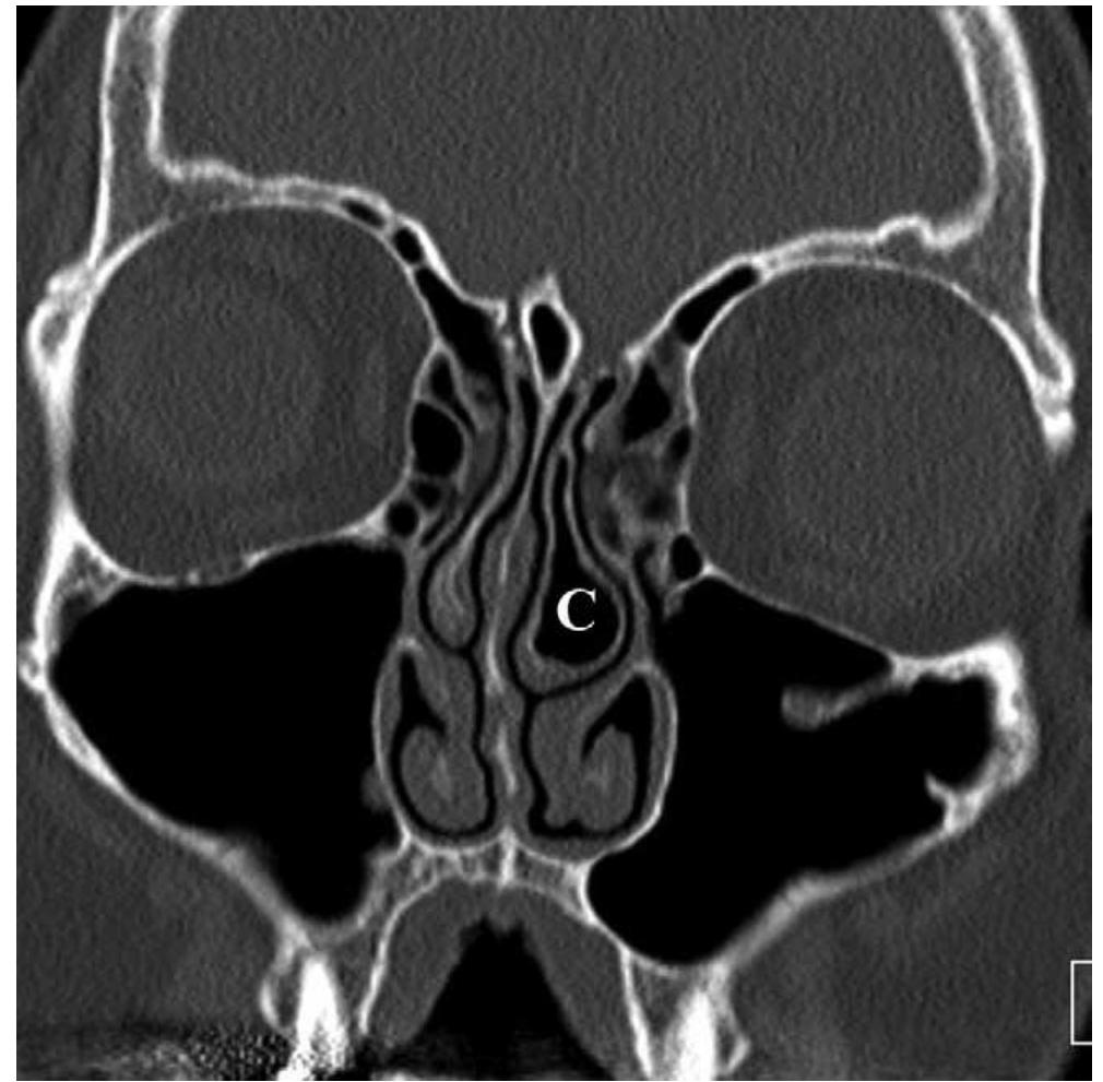 Concha bullosa. coronal ct of the paranasal sinuses in bone