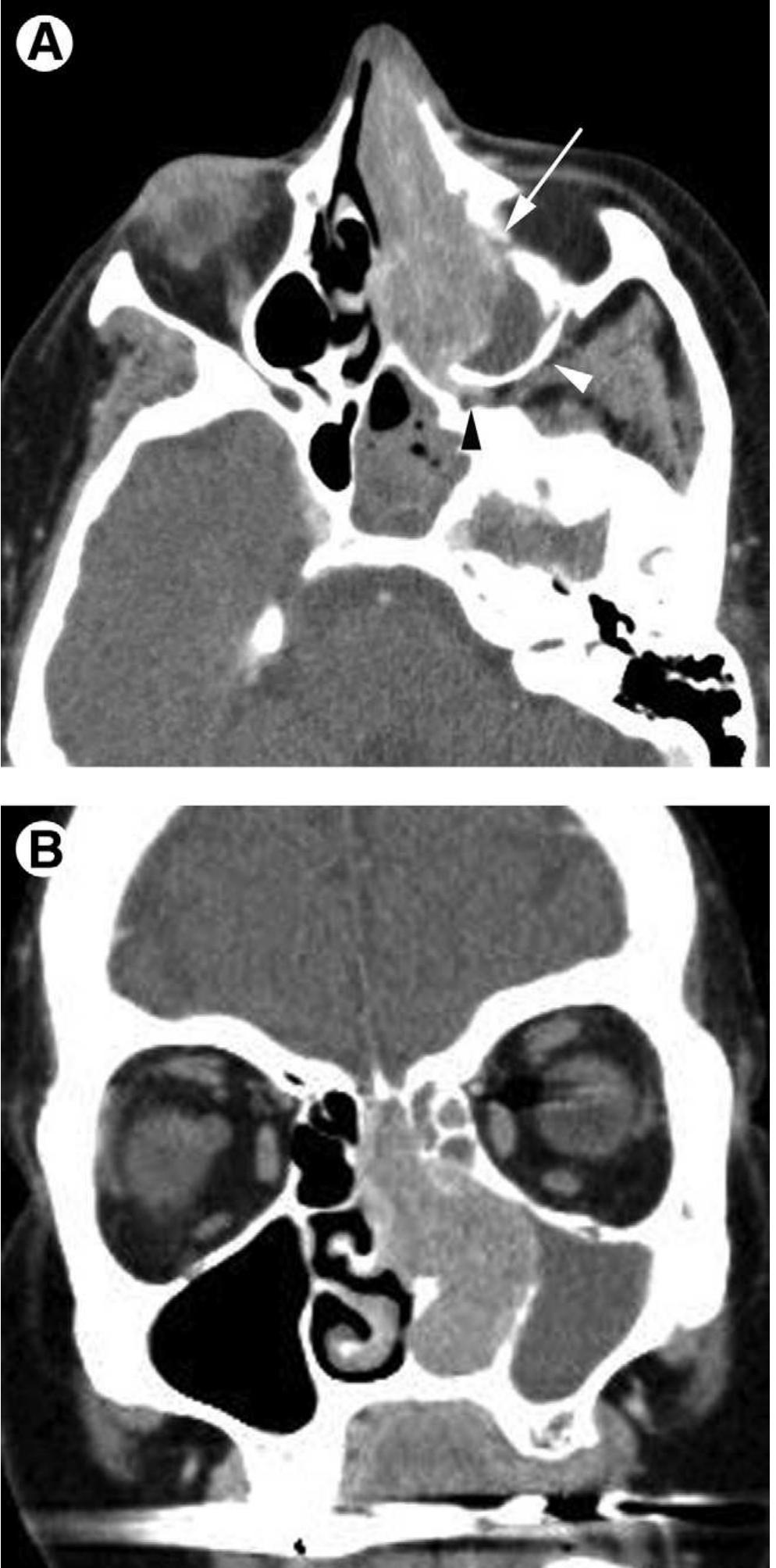 Nasal squamous cell carcinoma. a 63-year-old female with