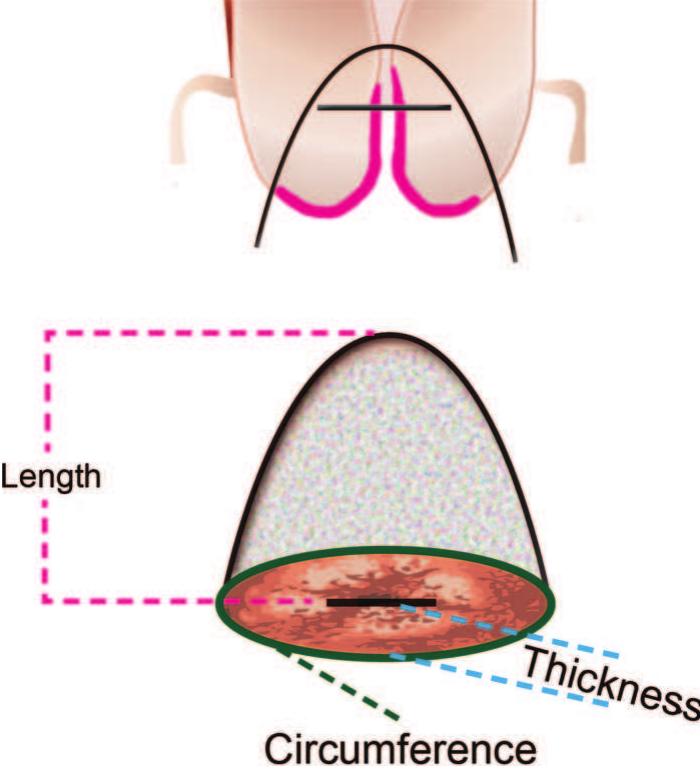 Line drawing of large loop excision of the transfor- mation
