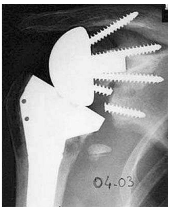 Anteroposterior radiograph of the right shoulder showing a