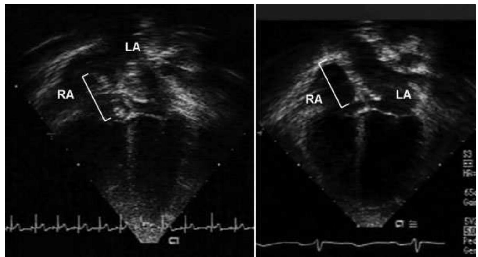 2-dimensional transthoracic 4-chamber images of a helex