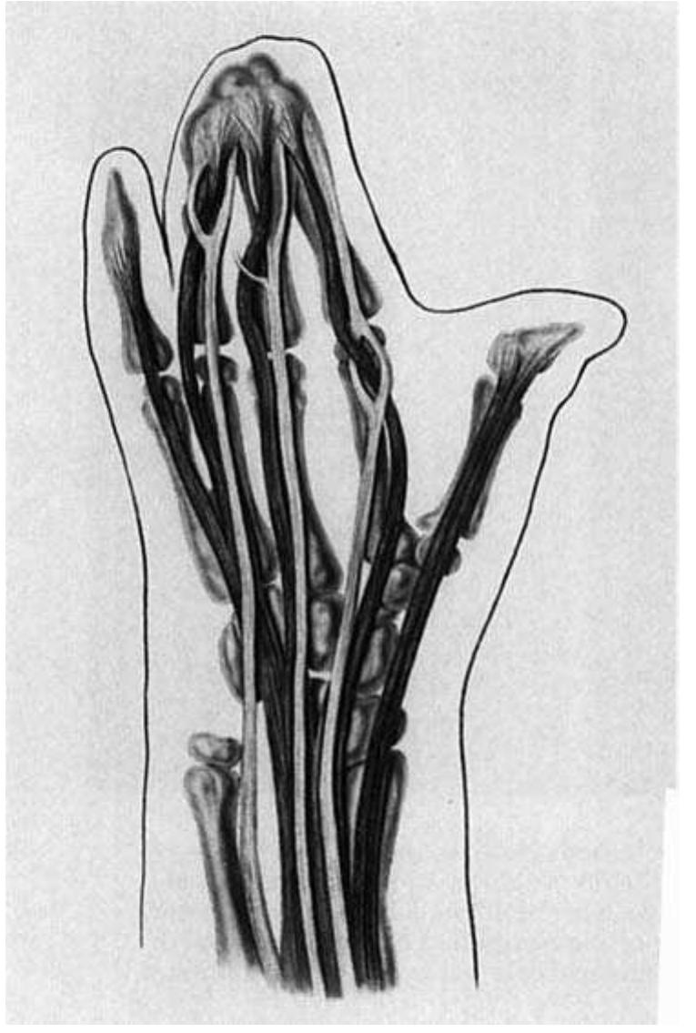Extrinsic flexor tendons. abnormalities of deep flexors