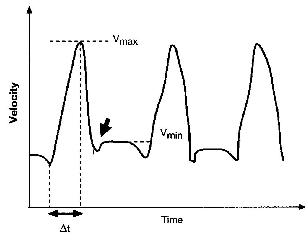 Diagram showing a doppler waveform and the dif- ferent