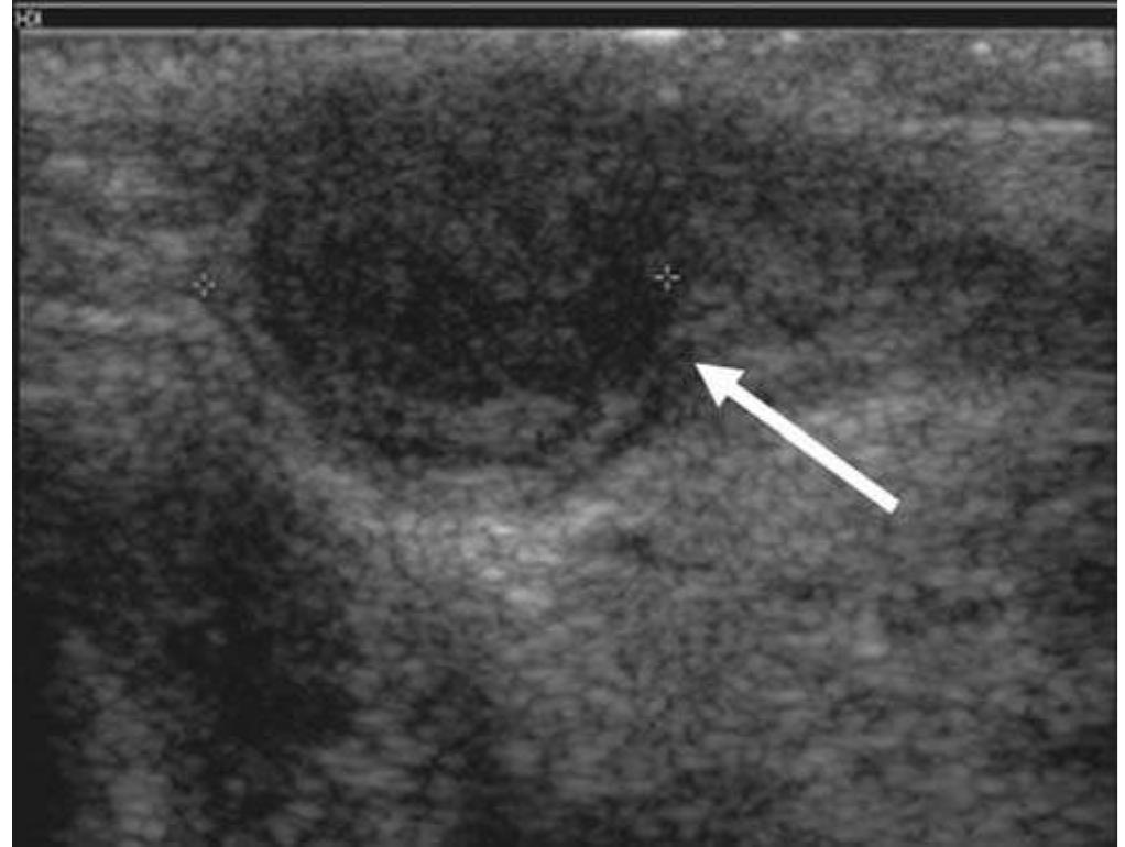 Post-traumatic cavernosal hematoma. the arrow depicts a