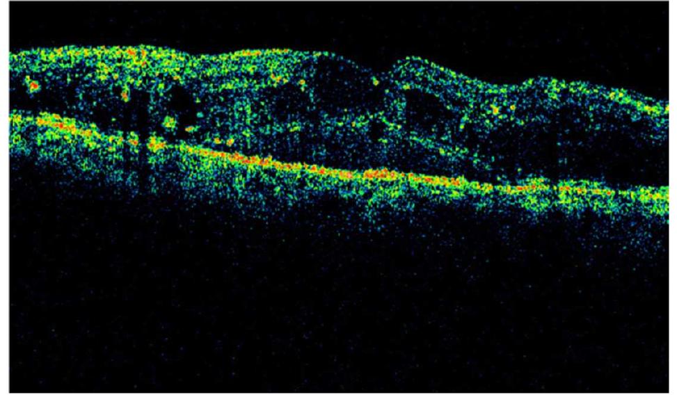 Stratus optical coherence tomography image. note: the