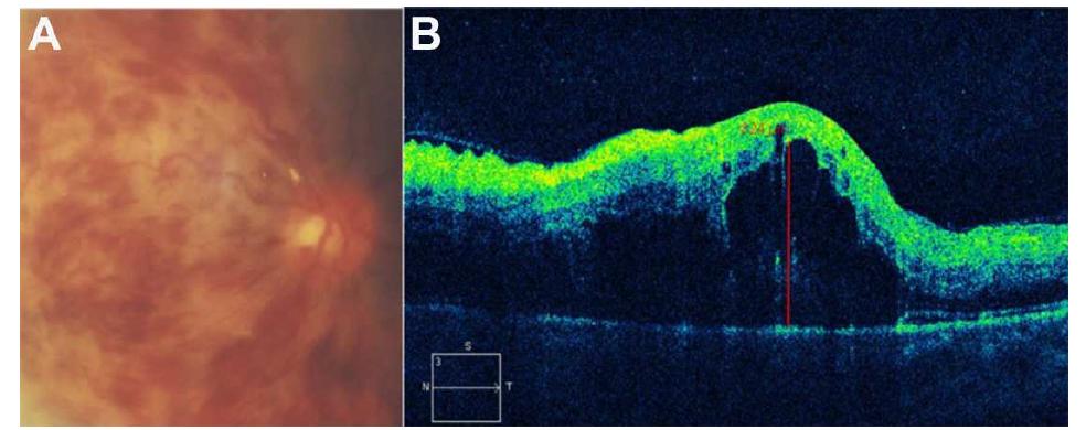Central retinal vein occlusion with macular edema. notes: