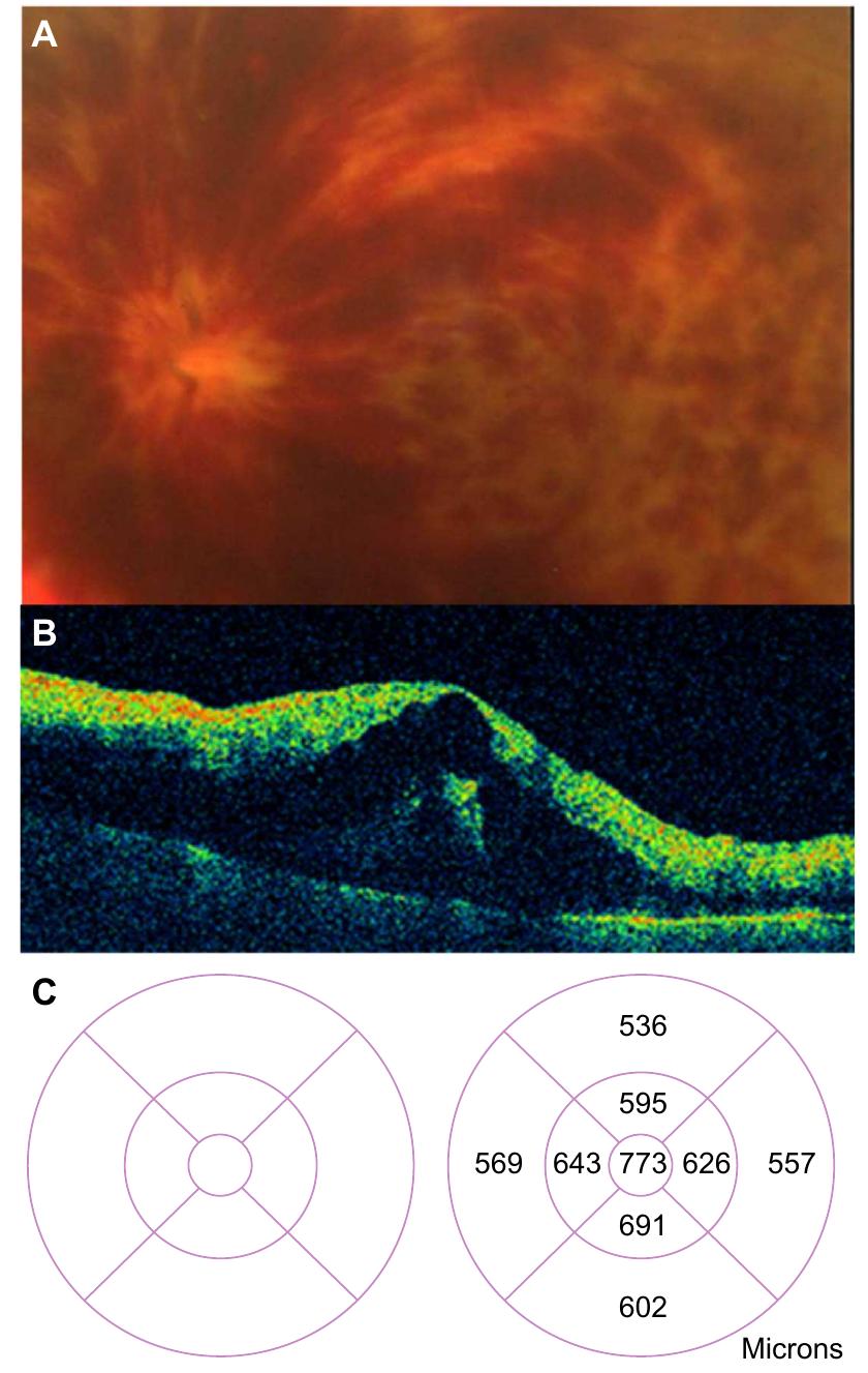 Acute central retinal vein occlusion with macular edema.
