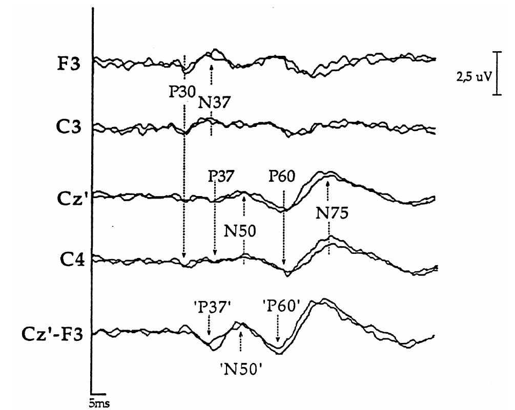 Scalp tibial nerve seps to right tibial nerve stimulation