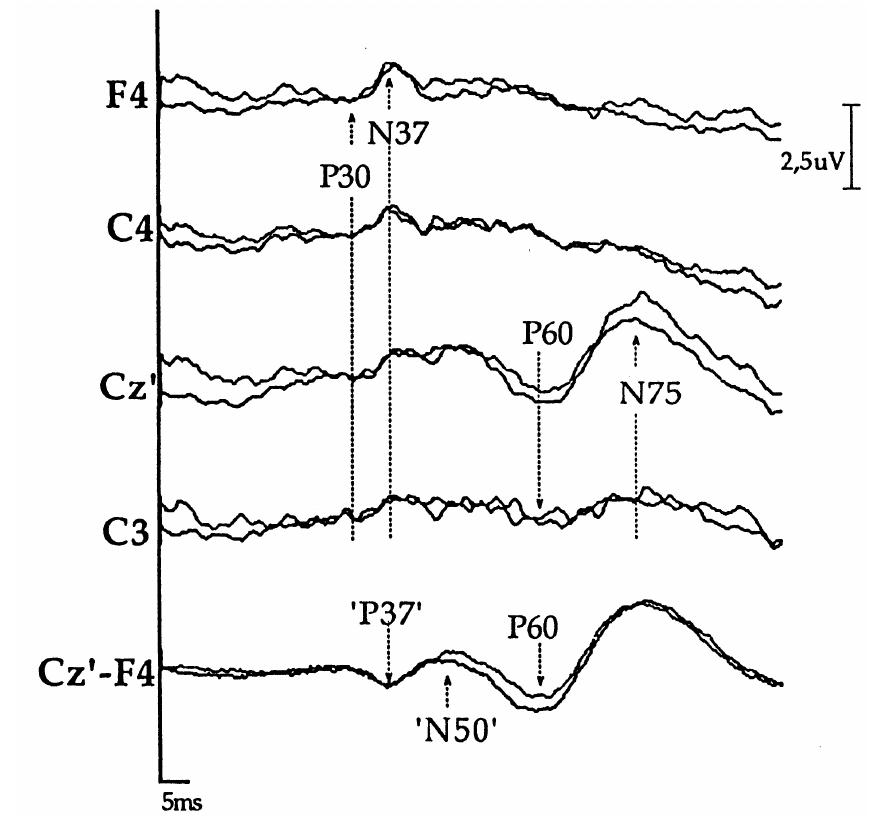 Scalp tibial nerve seps to left tibial nerve stimulation in