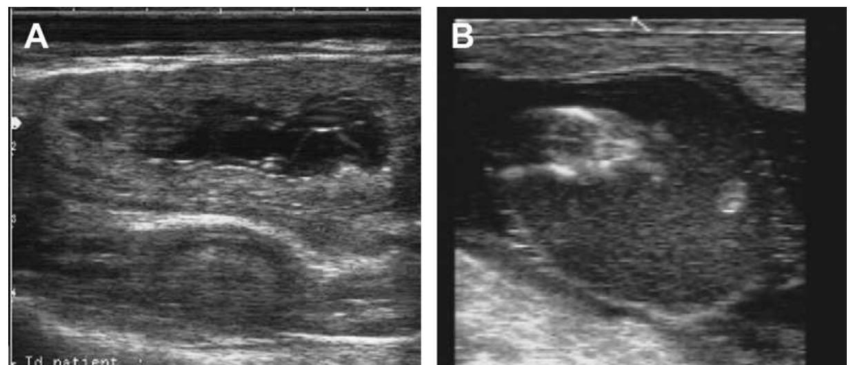Typical ultrasound images of embryonic and fetal death. (a)