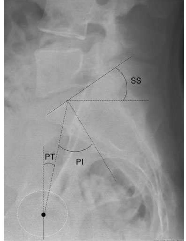 Lateral radiograph of the lumbosacral spine showing the