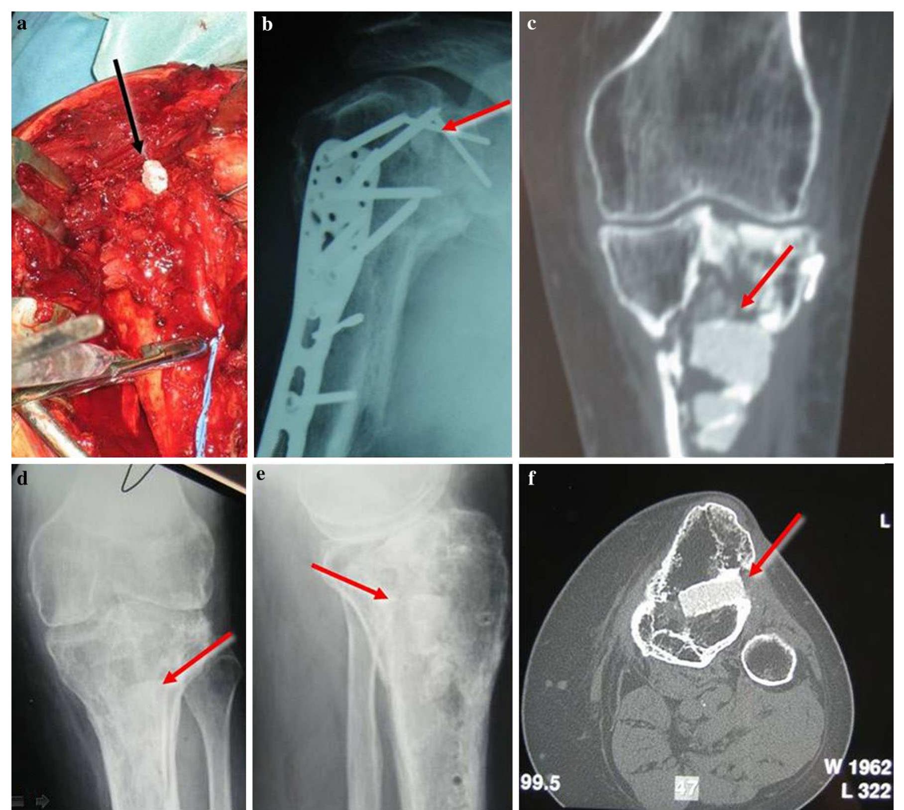 Inside the humeral head. e-f x ray and ct scan at 3 year of