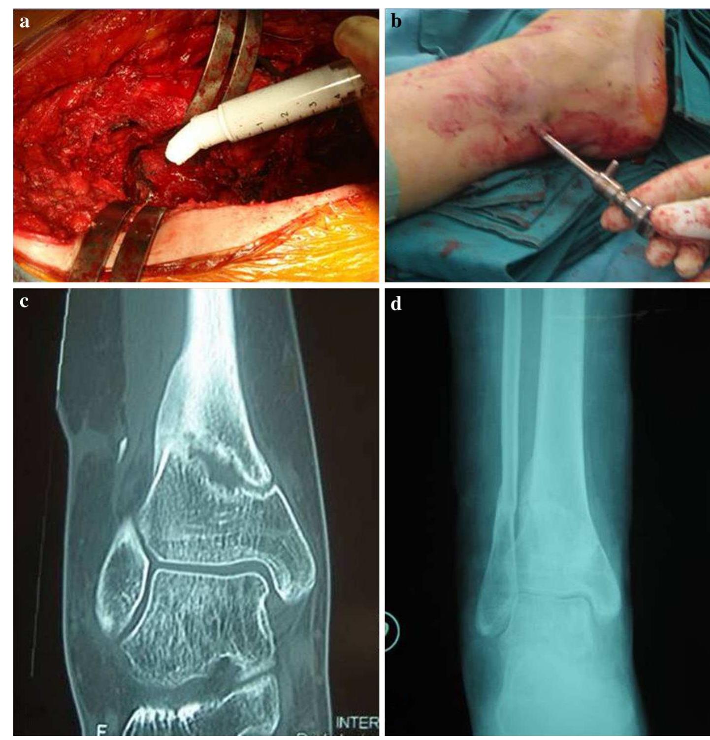 8 composite materials bone is mainly made of collagen (col)