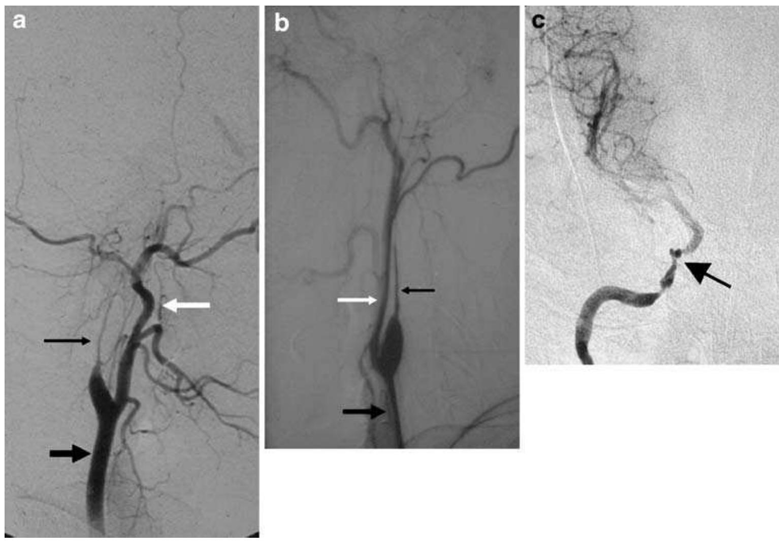 Serial imaging of ica and va dissections is required for the