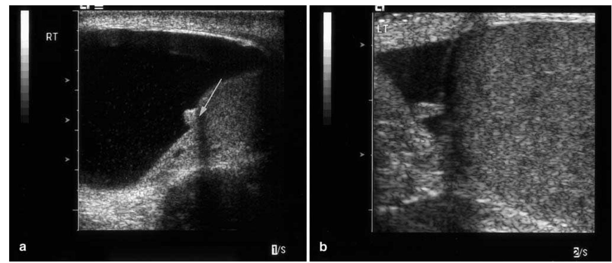 (PDF) Ultrasound appearances of the testicular appendages: pictorial review