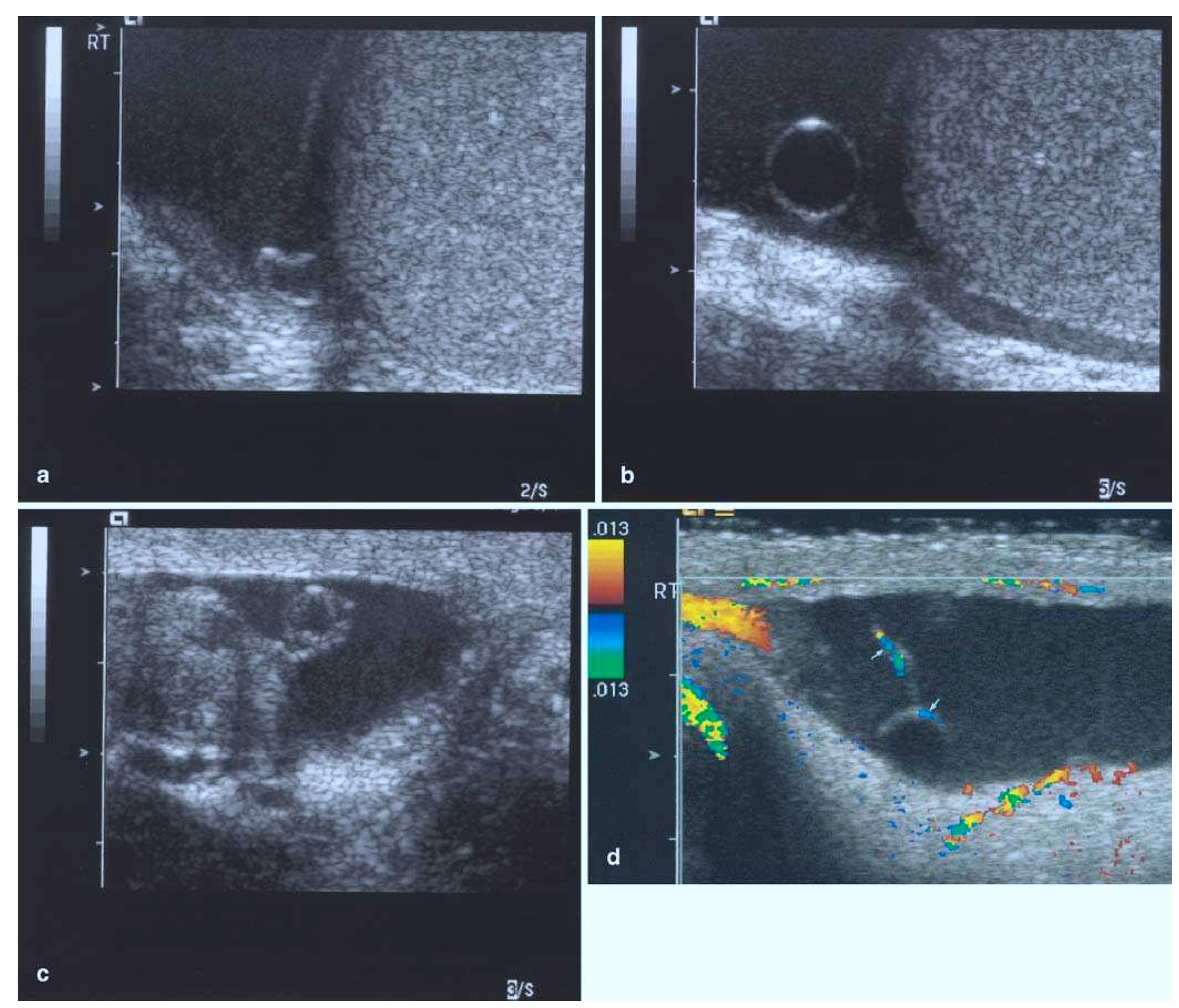 (PDF) Ultrasound appearances of the testicular appendages: pictorial review