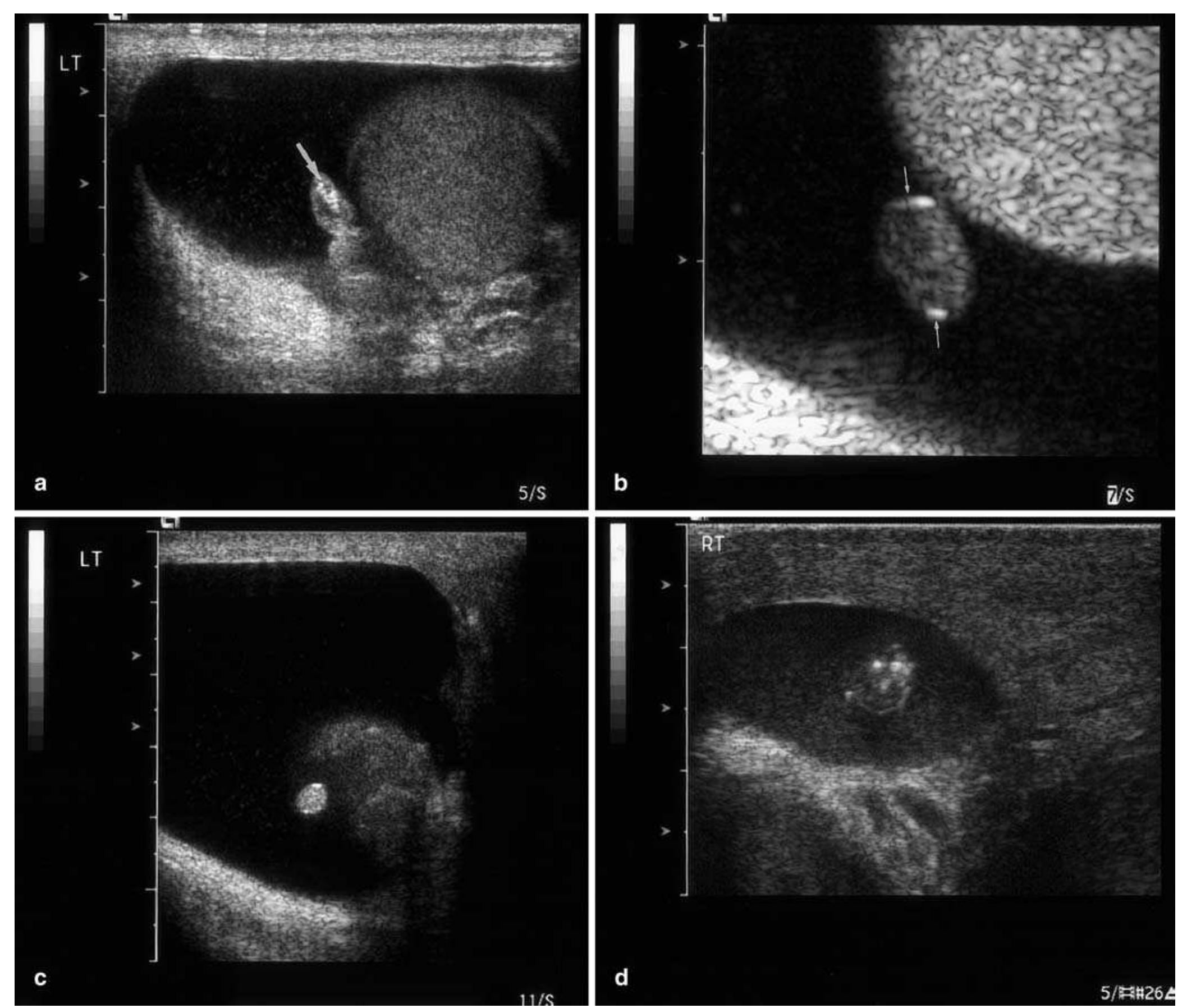 (PDF) Ultrasound appearances of the testicular appendages: pictorial review