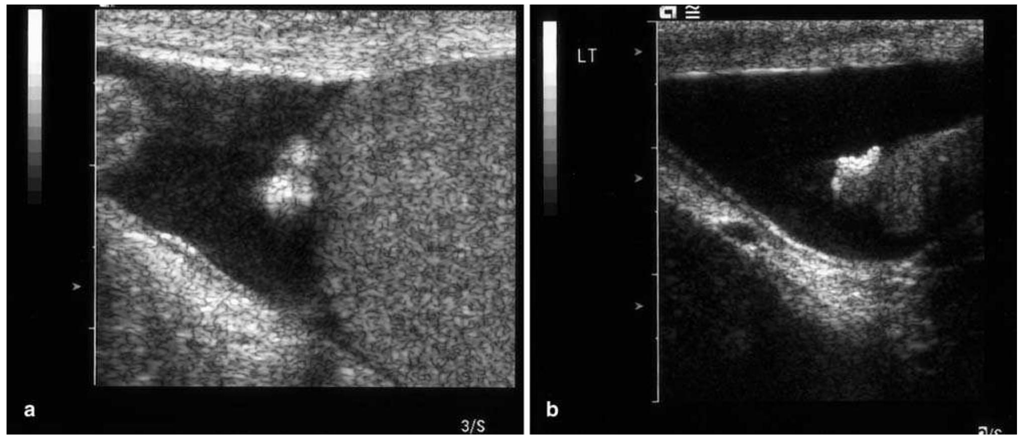(PDF) Ultrasound appearances of the testicular appendages: pictorial review