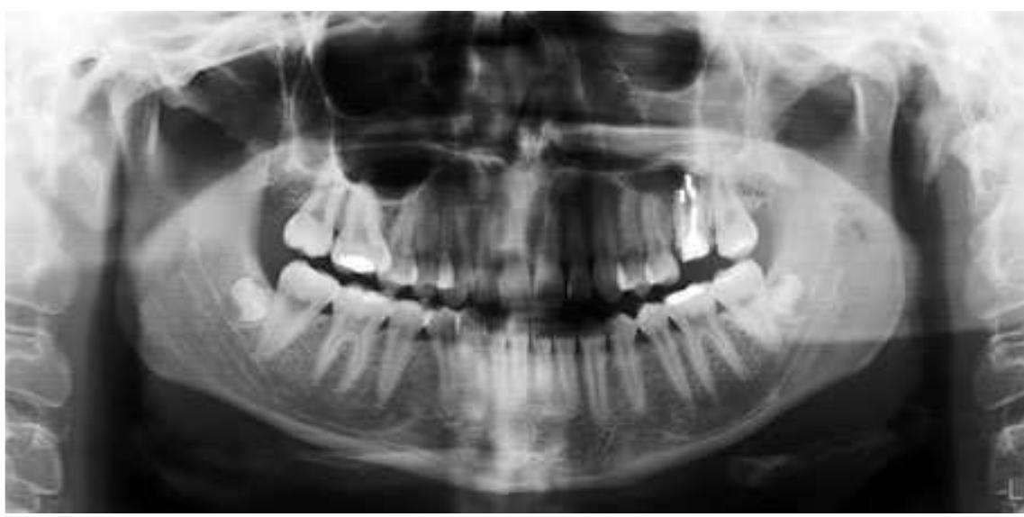 Panoramic radiography after periapical surgery. figure 6 the