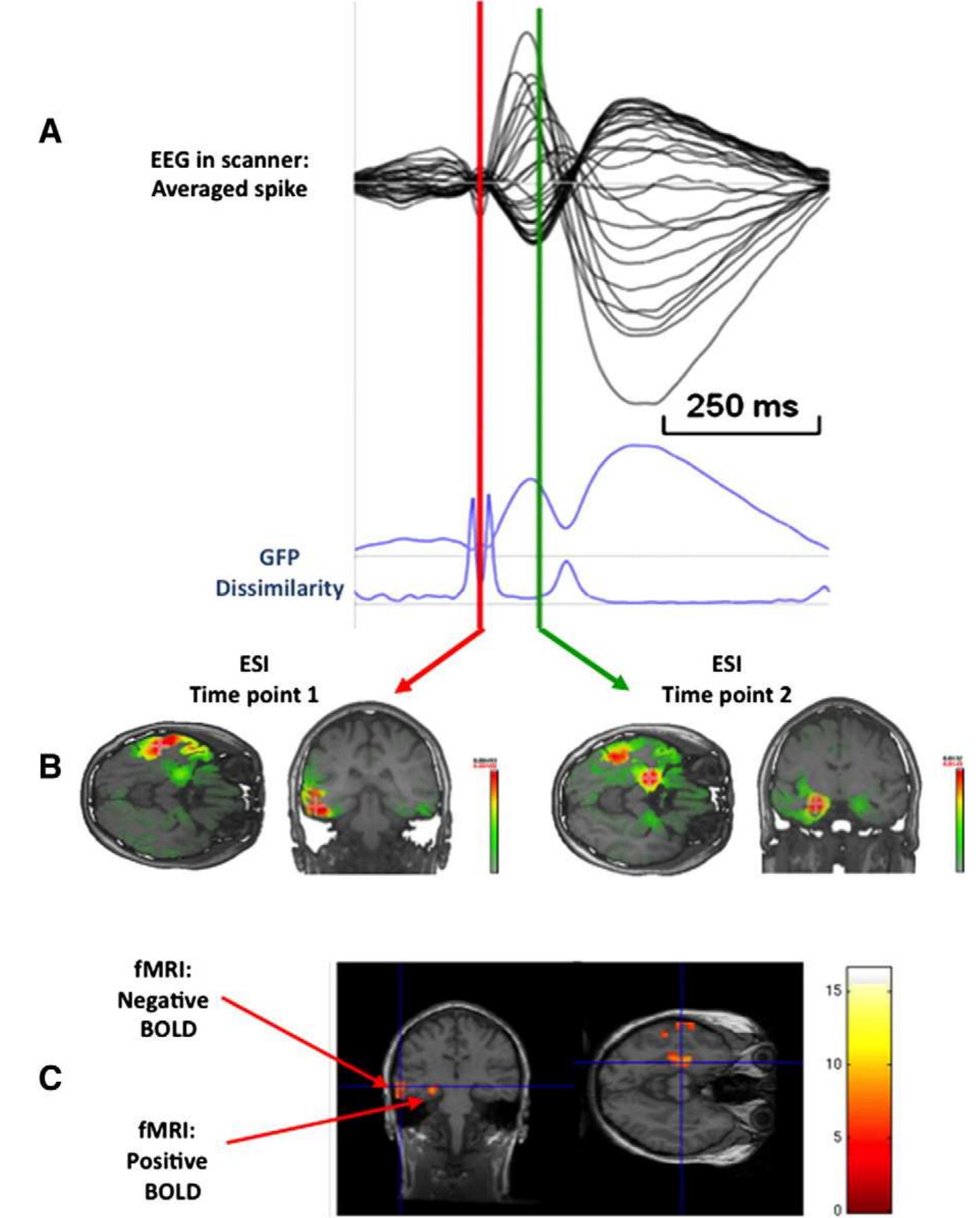 (a) combined eeg source imaging and fmri for the