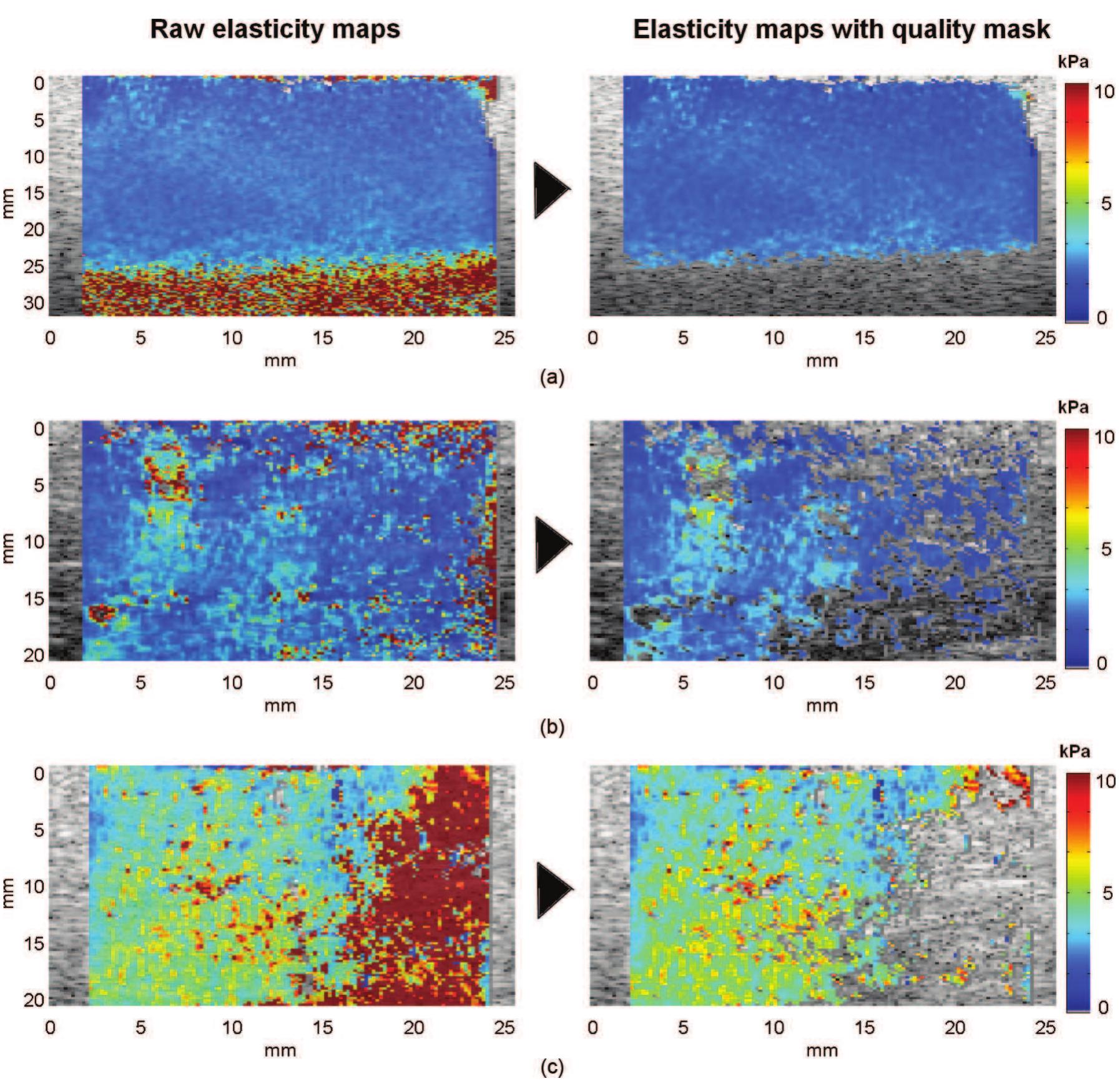Shear modulus maps of several supersonic shear imaging (ssi)