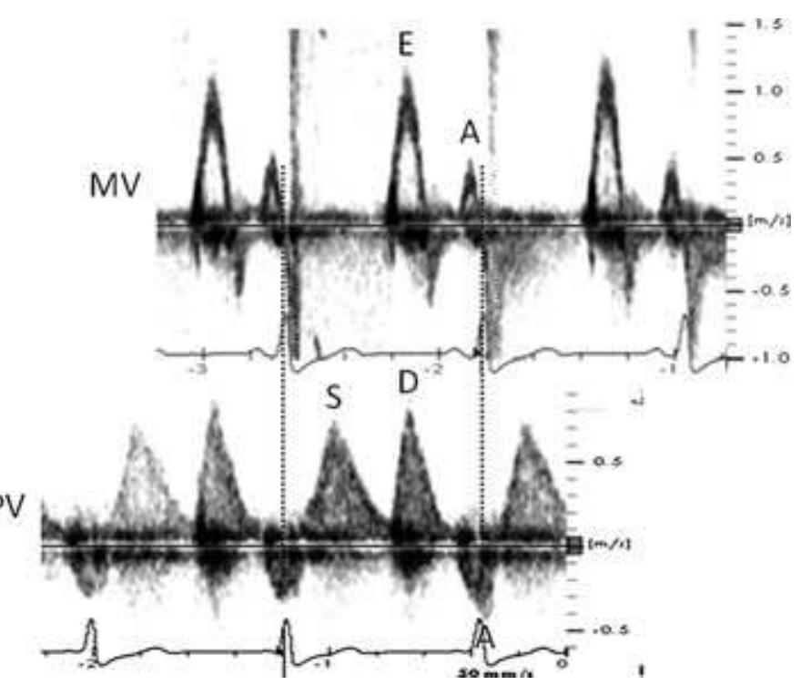 Pulse wave doppler of mitral valve (mv) and pulmonary vein