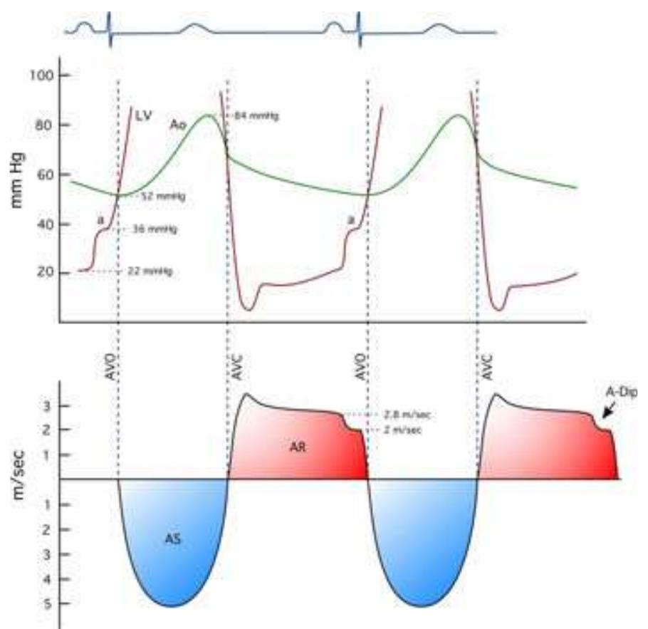 Schematic drawing of simultaneous left ventricle (lv) and