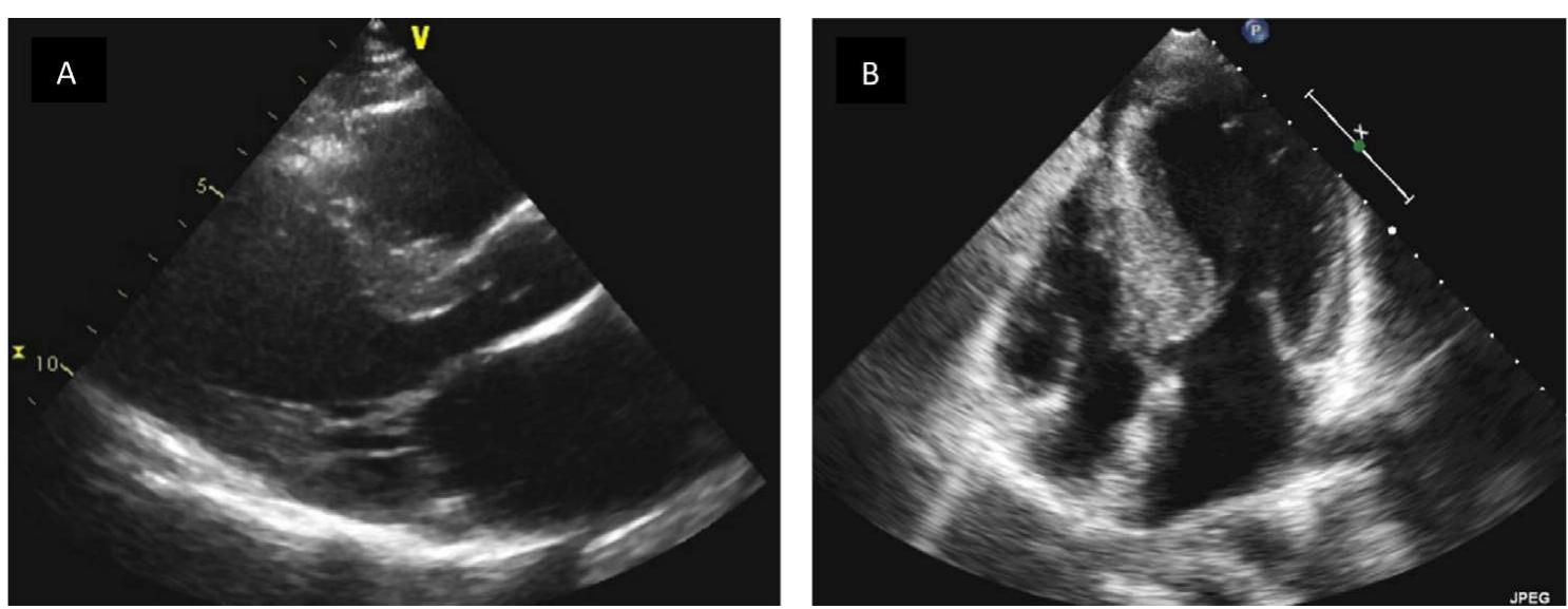 Parasternal long axis (a) and apical 4-chamber view (b) of