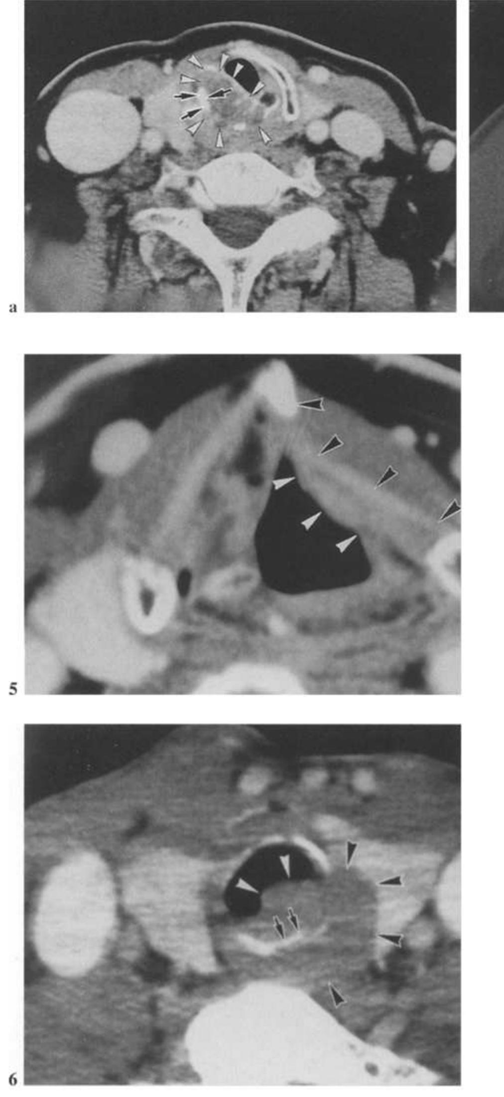 A (case 31) axial-enhanced ct. large lytic soft tissue mass