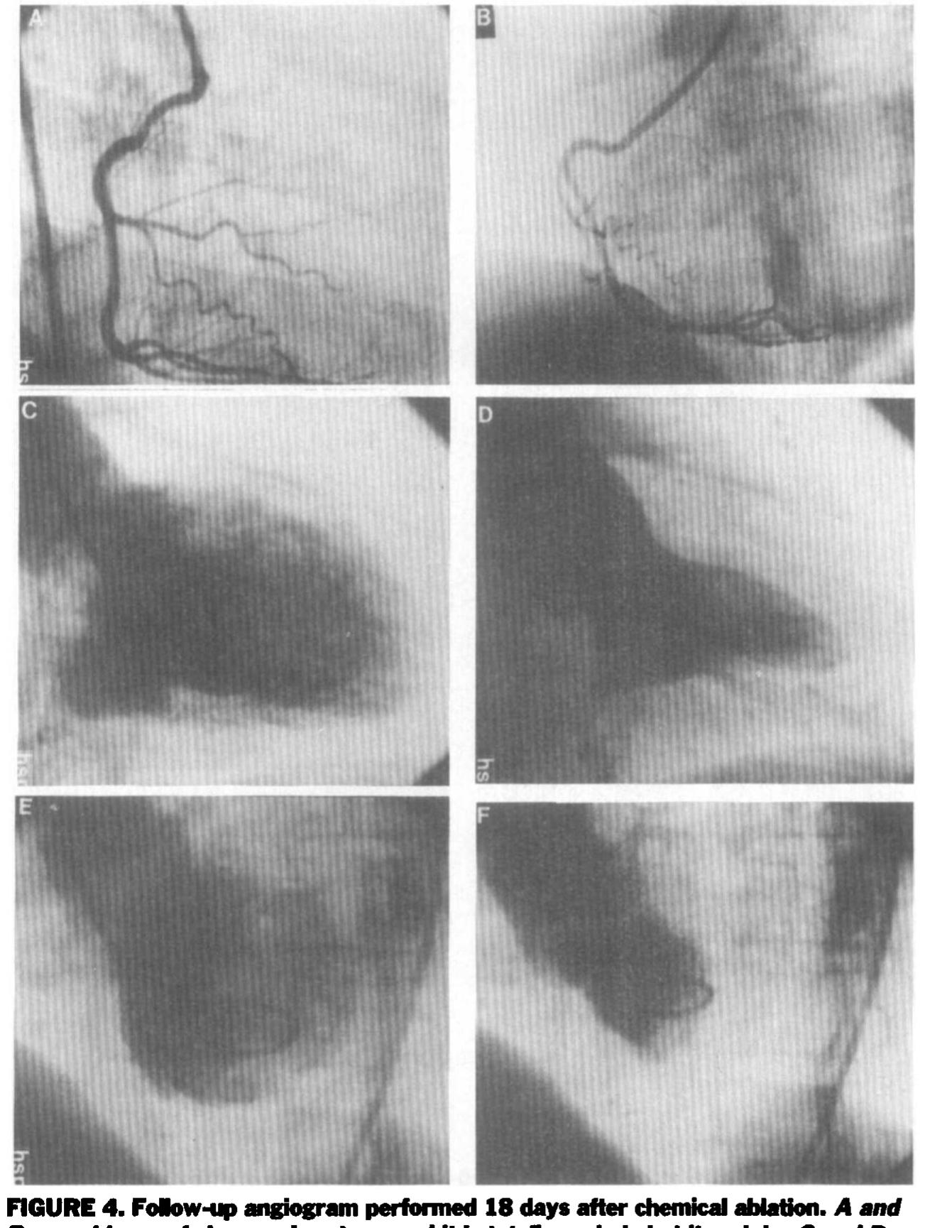 Figure 4 Sinus Node Artery Occlusion For Treatment Of