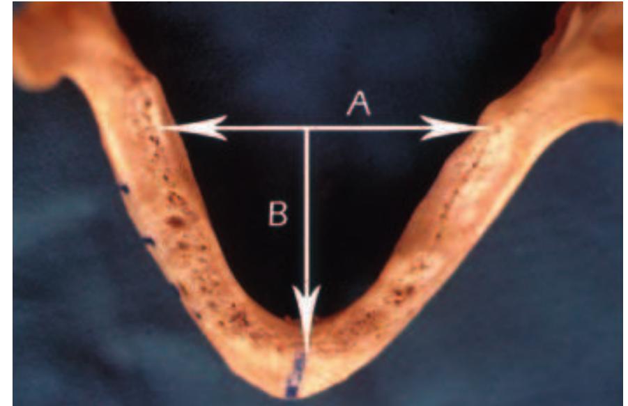 Width of the mandibular body arch was mea- sured at the